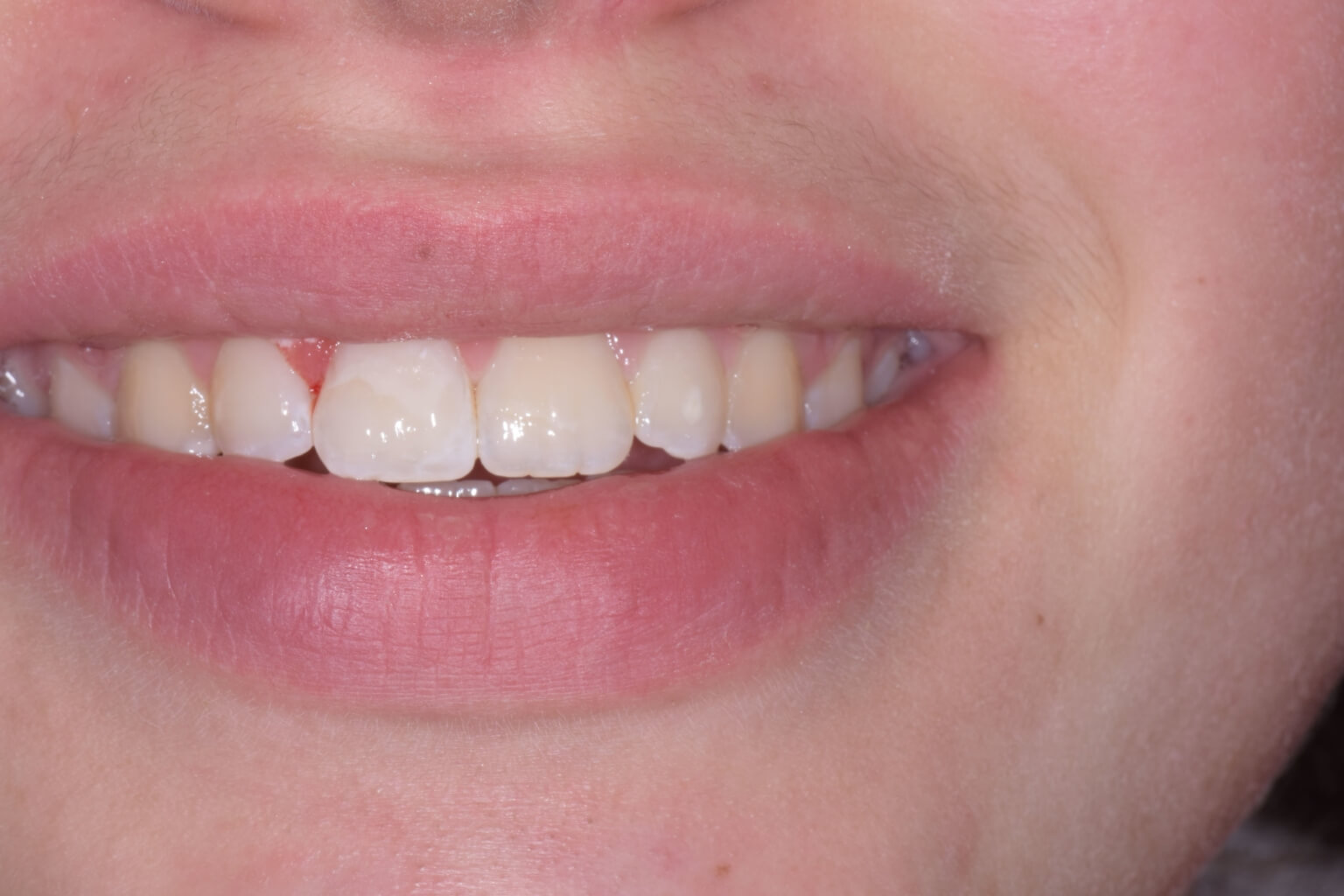 Traitement de l'émail - Cabinet dentaire du Dr Sophie Miannay